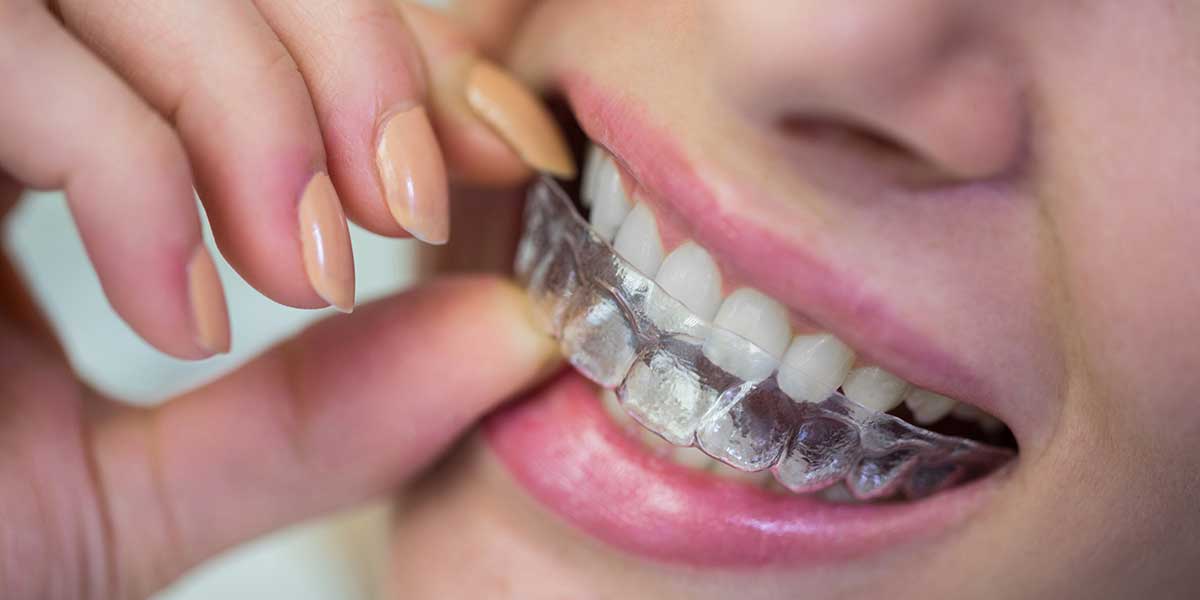 How Invisalign Can Help Correct Your Overbite